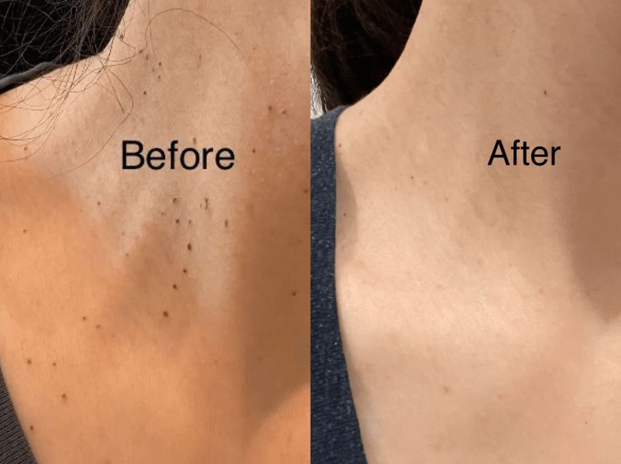 The Magic Eraser: Plasma Pen – Firecracker Beauty Spa